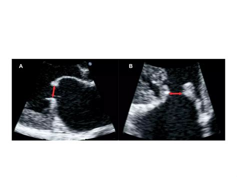 Echocardiography In Mitral Stenosis Pptx