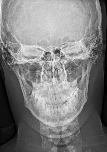 Mandibular Fracture X Ray