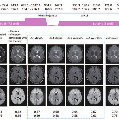 Mri Findings On Admission Mri T2wi Flair Dwi Showed Diffuse