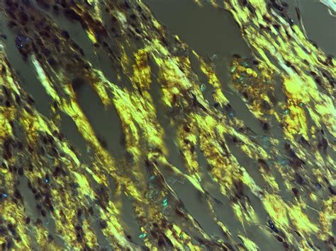 Amyloid Deposits In Skin W Brilliant Apple Green Birefringence On