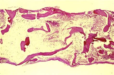 Aplastic Anemia And Myelodysplastic Syndrome Flashcards Quizlet