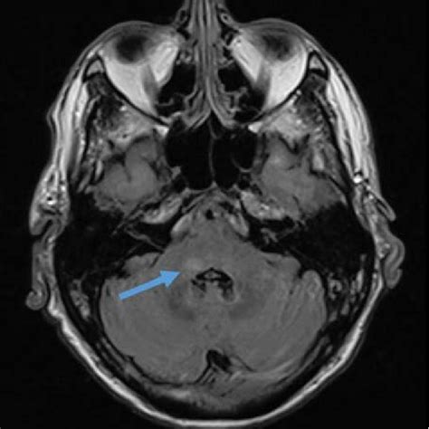Initial Mri Brain Flair Transversal Images With Multifocal Abnormal
