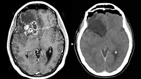Día Internacional De Los Tumores Cerebrales Neurocirugía Rubino