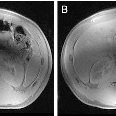 Detailed Imaging Parameters For The T2w Tse Sequence And Truefisp