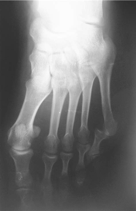 Figure 3 From Irreducible Dorsal Metatarsophalangeal Joint Dislocation
