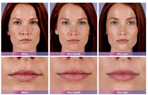 Juvederm Ultra Plus Before And After Lipstick