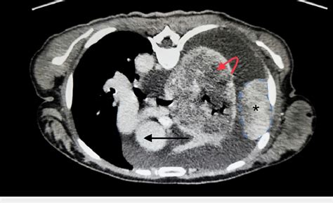 Computed Tomography Ct Of Chest With Contrast Axial View Showing