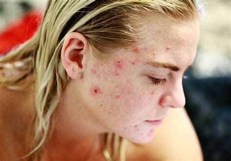Rosacea Causes Triggers And Skincare Routine For Rosacea Artofit
