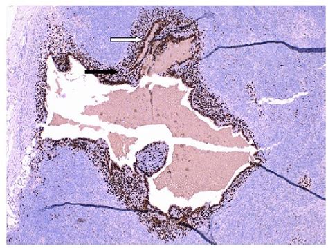 Figure 32 From Endometriosis And Regional Lymph Node Involvement In