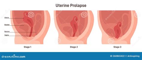Prolapsed Uterus Stages