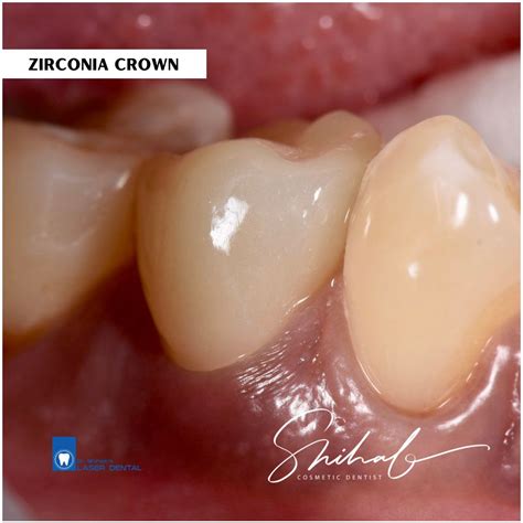 Shihabur Rahman On Linkedin Laserdental Digitaldentistry