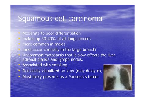 Lung Cancer Presentation Finalpdf