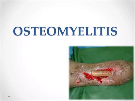Osteomyelitis Pptx
