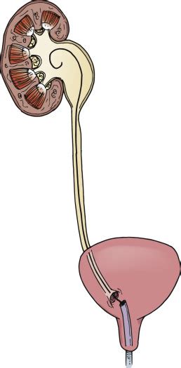 Ureteroscopic Endopyelotomy And Endoureterotomy Abdominal Key