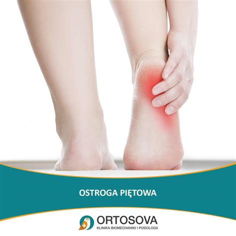 Ostroga piętowa jak z nią walczyć ORTOSOVA Klinika Biomechaniki i