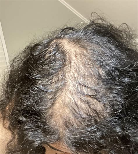 Update 10 Months Dutasteride 1 Mg Daily And 25 5mg Oral Minoxidil