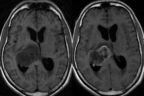 Glioma Glioma Mri