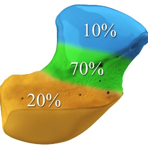 Herbert Classification Of Scaphoid Fractures Type A Fractures Are
