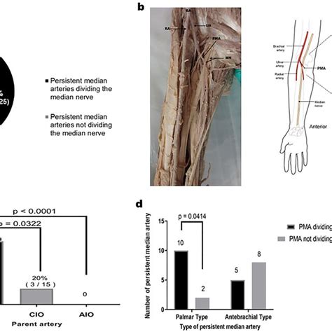 Division Of The Median Nerve By The Persistent Median Artery A Download Scientific Diagram
