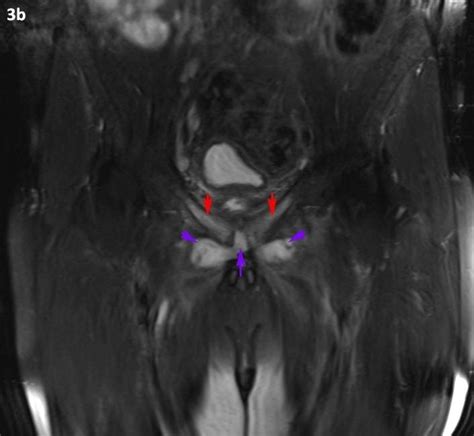 Osteomyelitis Os Pubis Pacs