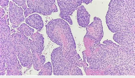 Low Power Slide Demonstrated Pleomorphic High Grade Undifferentiated Download Scientific