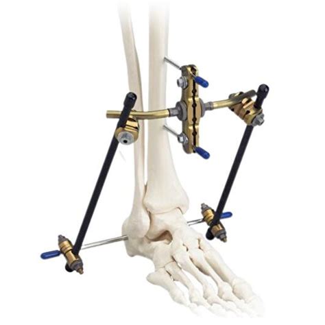 Large And Medium External Fixation System Kalteq