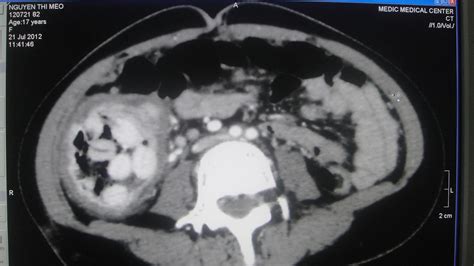 Vietnamese Medic Ultrasound Case 132ovarian Tumors And Colon Tumor