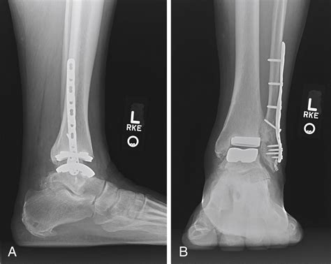 Total Ankle Arthroplasty Clinical Tree