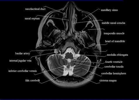 Mri Anatomy Brain Axial Image 16 Brain Anatomy Mri Br