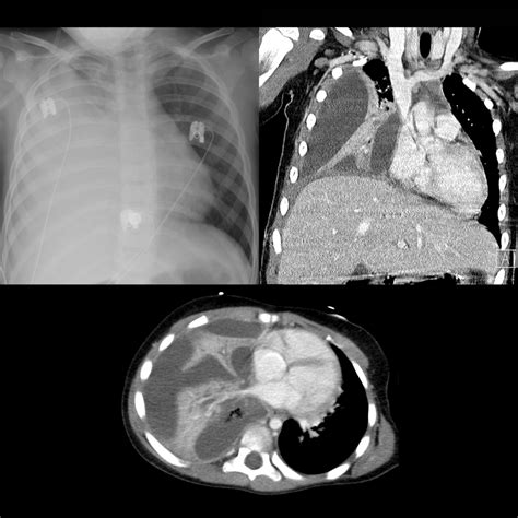 Pediatric Staphylococcus Pneumonia Pediatric Radiology Reference Article Pediatric Imaging