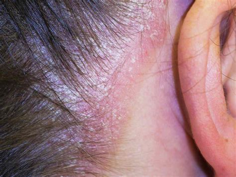 16 Kinds Of Skin Rashes Treatments Pictures And More