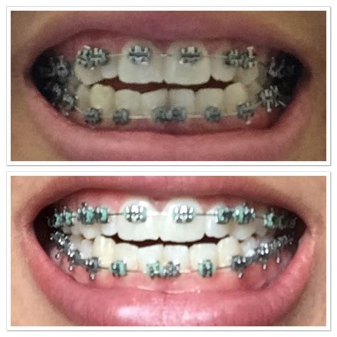 How Long To Wear Retainers After Braces Trending Now