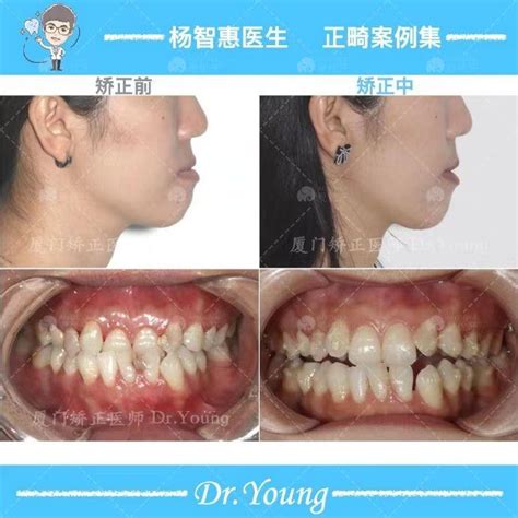 厦门牙齿矫正2颗虎牙缺失地包天隐形矫正中病例分享 知乎