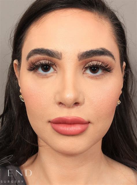 Rhinoplasty Fat Grafting 18 Days Post Op
