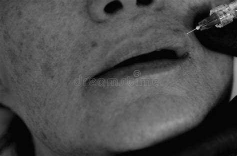 Filler Injections Closeup Mature Woman Lips Procedure Augmentation