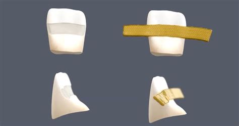 Dentapreg Composite Anterior Bridge Dr Eric Van Zytveld Odonto Tv
