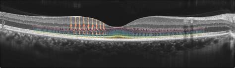 Cross Sectional High Resolution OCT B Scan Of A Healthy Year Old Man Download Scientific