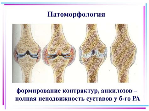 Ревматоидный артрит Лекция №15 презентация онлайн
