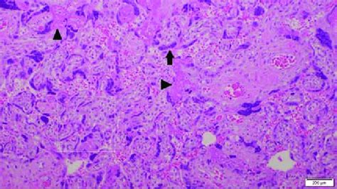 Histopathology Of The Placenta A Photomicrograph Showing Areas With
