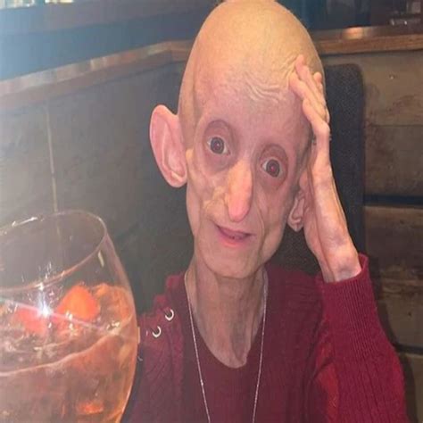 Hutchinson Gilford Progeria Syndrome Body