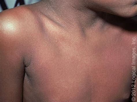 Blanching Diffuse Sandpaper Like Rash And Fever What Is The