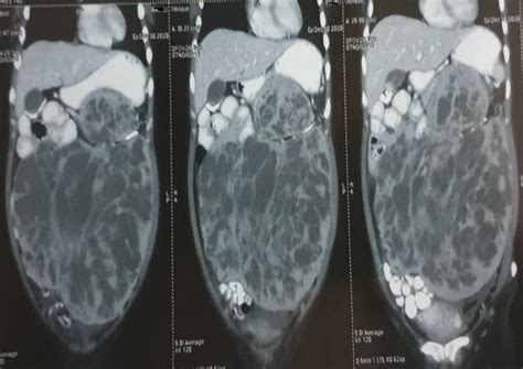 Cect Lower Abdomen Showing Extent Of Tumor In Pelvis Download Scientific Diagram