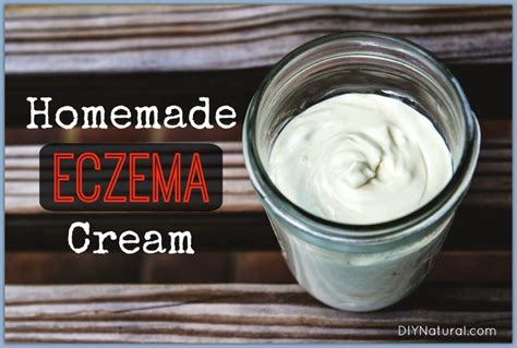 Homemade Eczema Cream A Natural Solution That Works