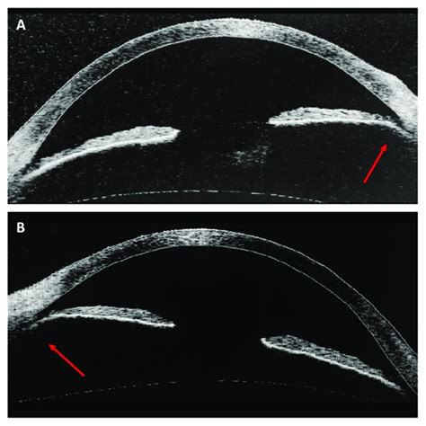 Grading Of Angle Recession [61] Download Scientific Diagram