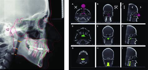 Two Dimensional Lateral Cephalometric Evaluation Versus Three
