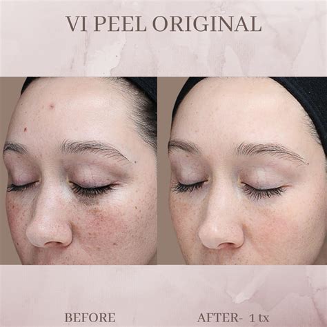 Vi Peel Eluma Laser And Aesthetics