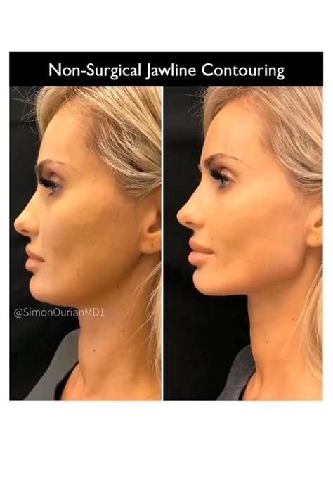 Jawline Contouring By Dr Simon Ourian Video Face Makeover Facial Fillers Beauty Procedures