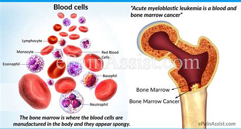 Acute Myeloblastic Leukemia Or Acute Granulocytic Leukemiacausessigns