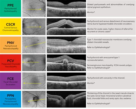 All The Colours Of The Pachychoroid Spectrum Mivision