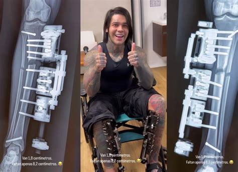 Video Yeferson Cossio Mostró Nuevos Avances De Su Cirugía De